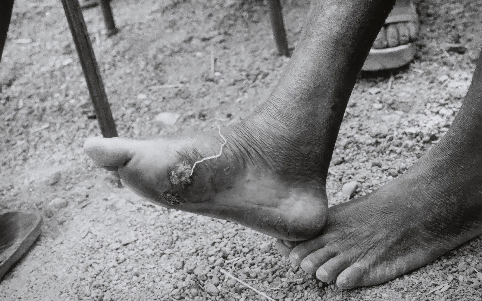 Good news: Guinea worm disease is on the verge of eradication